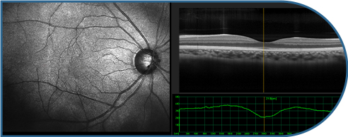 Our Technology | iSight Optometry | Kelowna